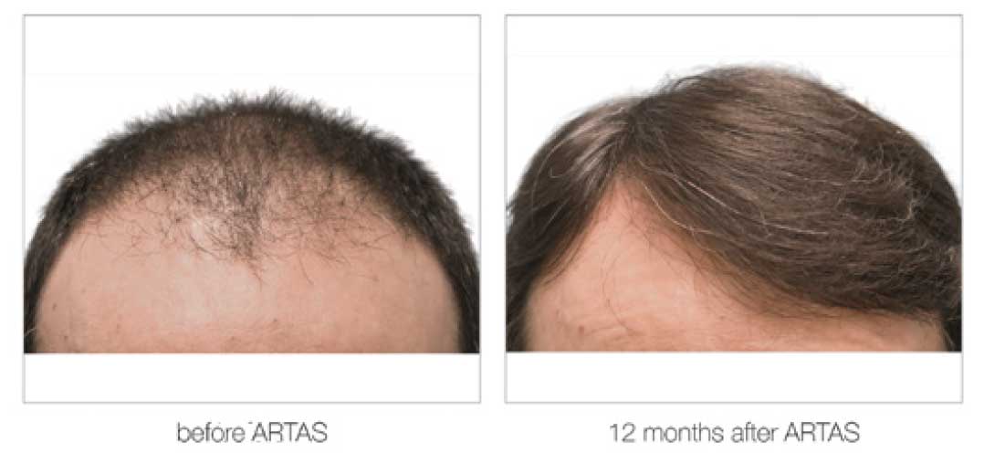 The Next Big Thing; Hair Restoration | California Hair MD