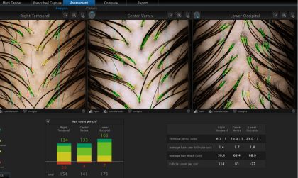 Best Hair Matrix System San Diego & Newport Beach | California Hair MD